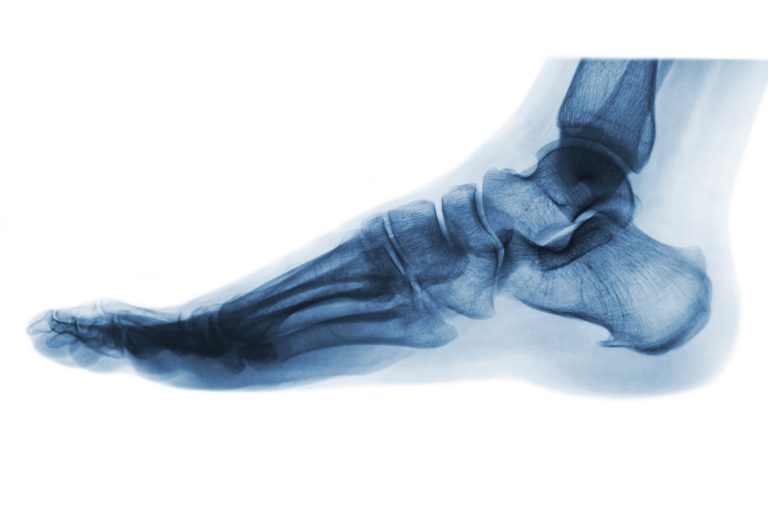Overlapping Toes - AOA Orthopedic Specialists