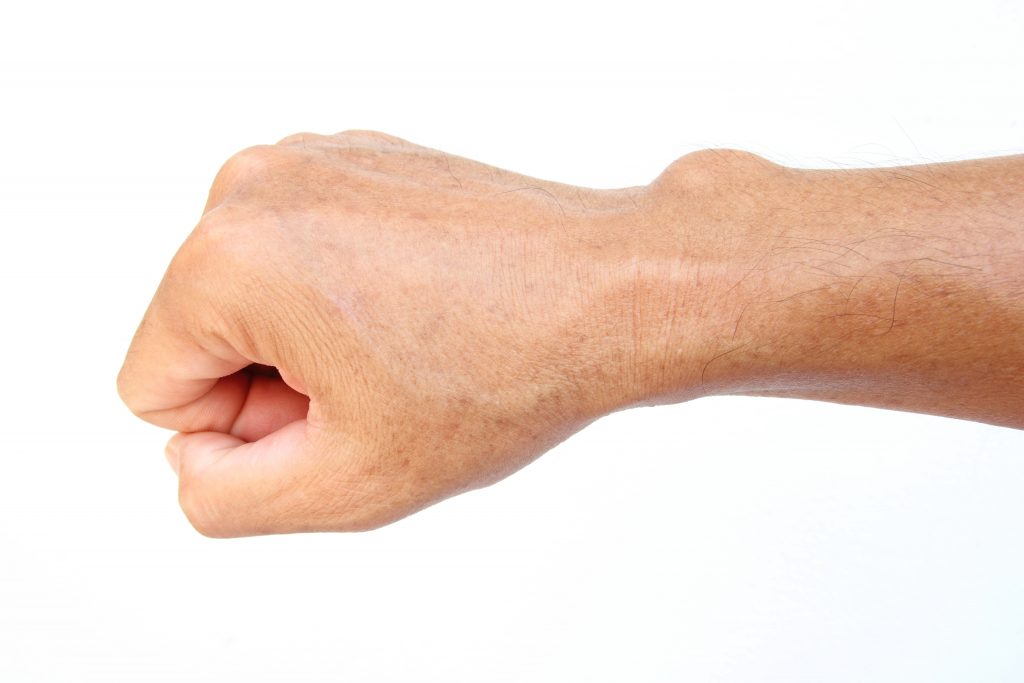 Cyst on a hand - AOA Orthopedic Specialists
