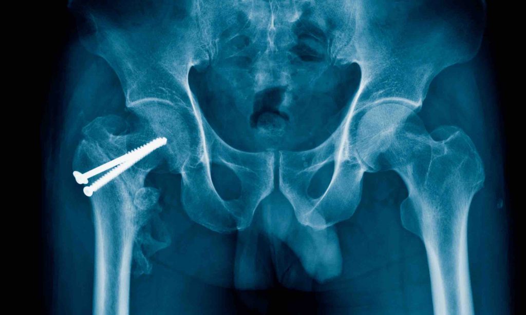 Fixation hip by screw x-ray, image of x-ray hip fracture and post ...