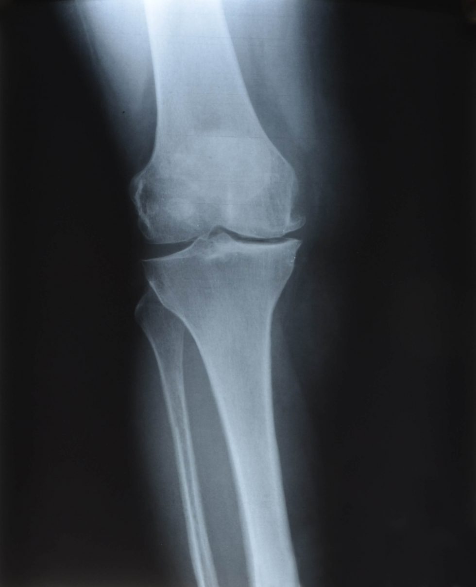 Subluxation - AOA Orthopedic Specialists