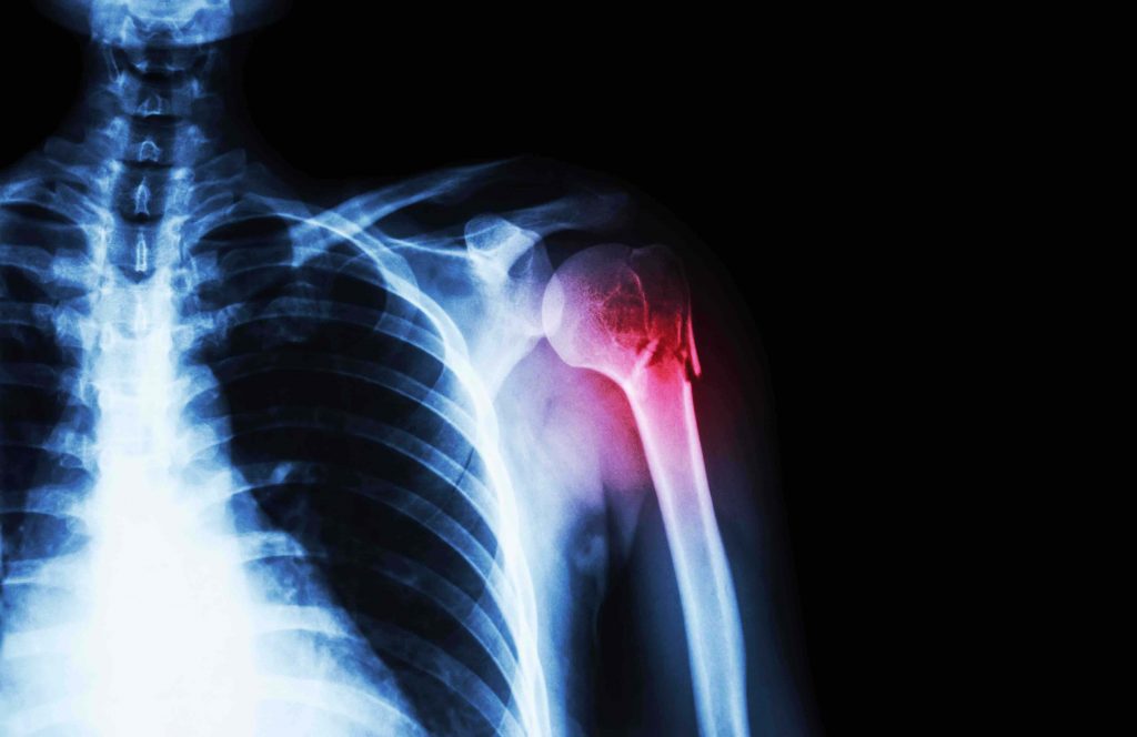 Shoulder - Shoulder Dislocations - AOA Orthopedic Specialists