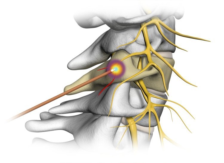 Cervical Radiculopathy Pinched Nerve In Neck AOA