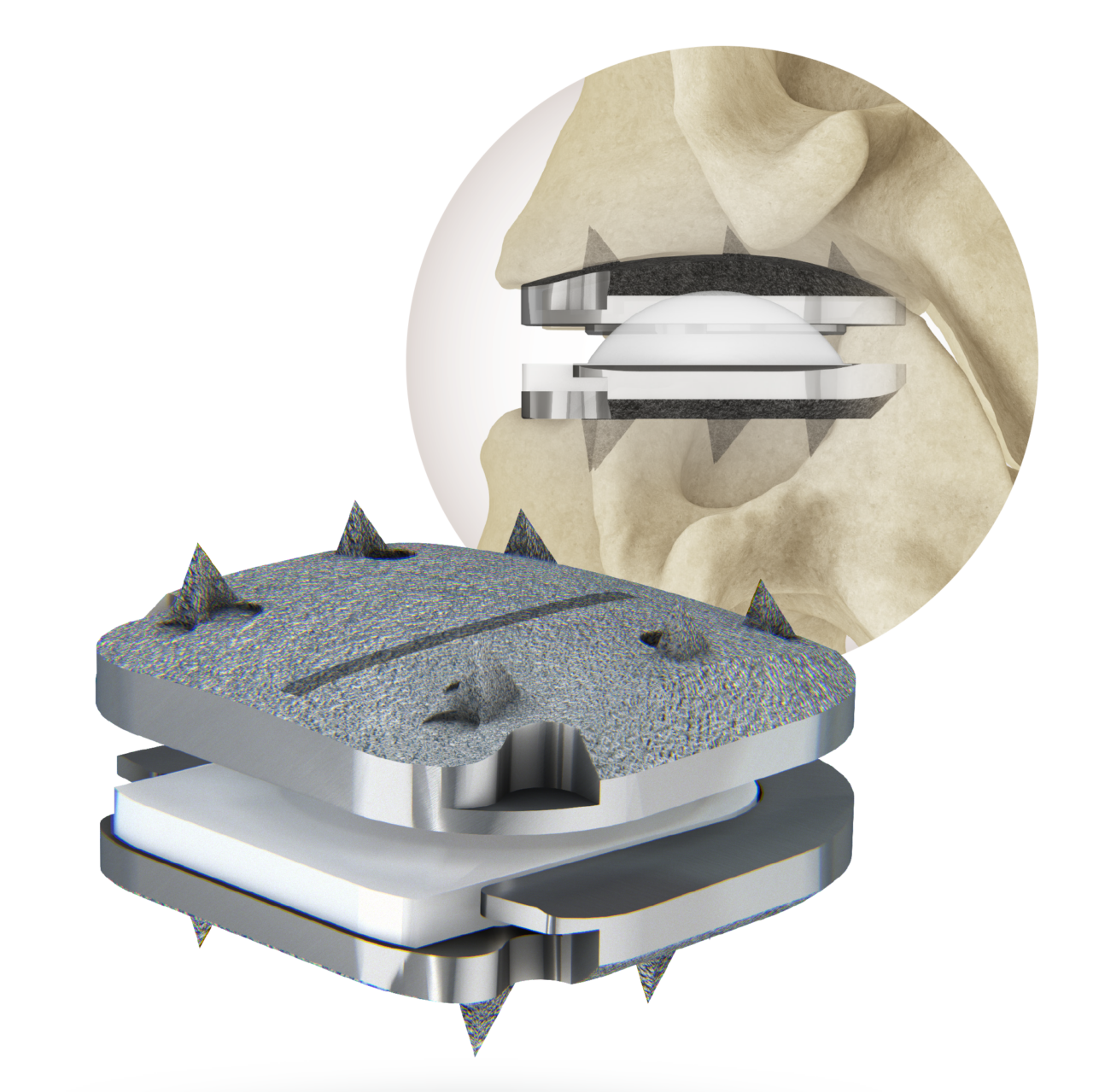 Cervical Disc Replacement - AOA Orthopedic Specialists