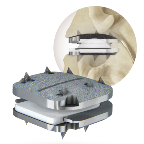 Cervical Disc Replacement - AOA Orthopedic Specialists