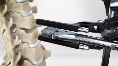 Video Thumbnail: prodisc C Vivo Surgical Technique with prodisc ...